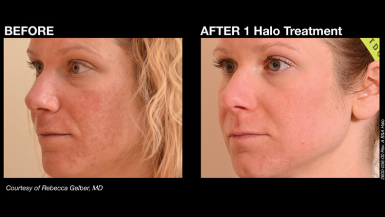 What Makes Halo™ Hybrid Fractional Laser Different from Other Laser ...